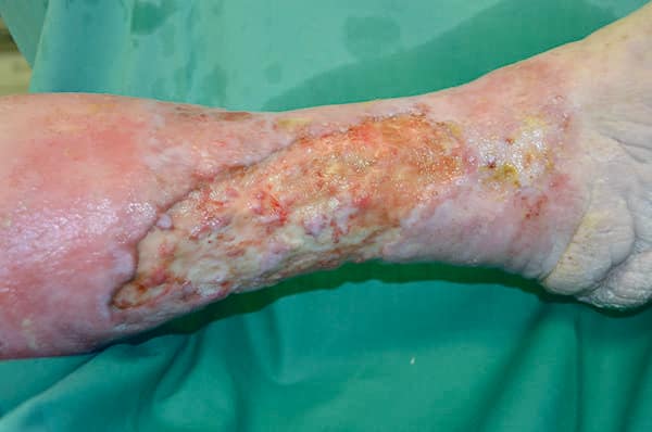 Wundinfektion erkennen und behandeln | Coloplast Wundversorgung