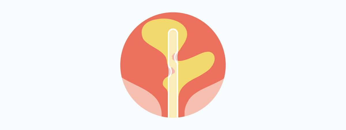 Urethral and bladder microtrauma