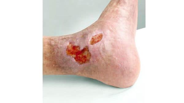 Ulcus cruris (offenes Bein): Symptome & Therapie | Coloplast Wundversorgung