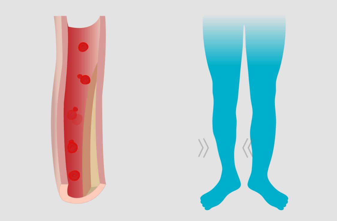 Klinische Videos | Coloplast Wundversorgung